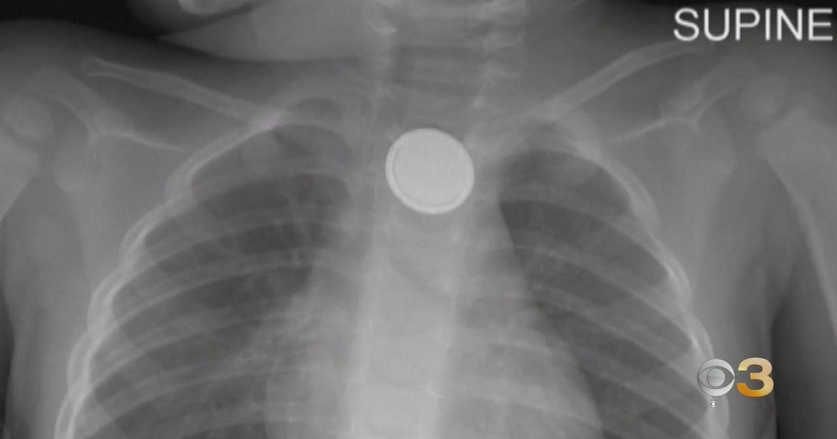 Injuries from button batteries among children growing, research finds ...