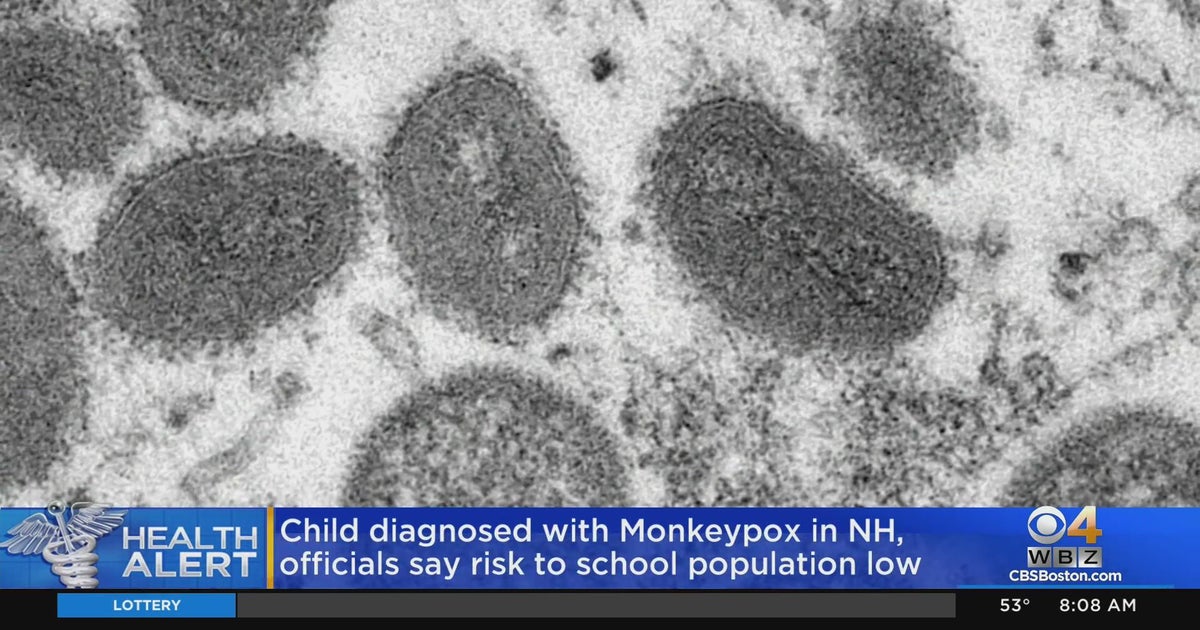 New Hampshire reports first case of monkeypox in a child - CBS Boston