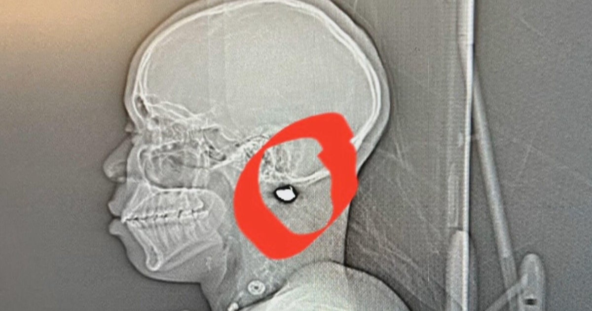 Colorado Springs teen lives with bullet in his head after shooting ...