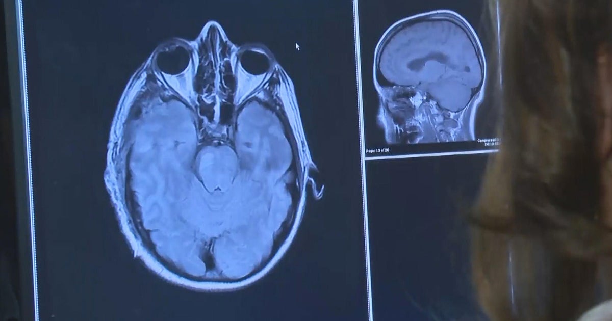 Retired NFL players with history of concussions have reduced cognitive ...