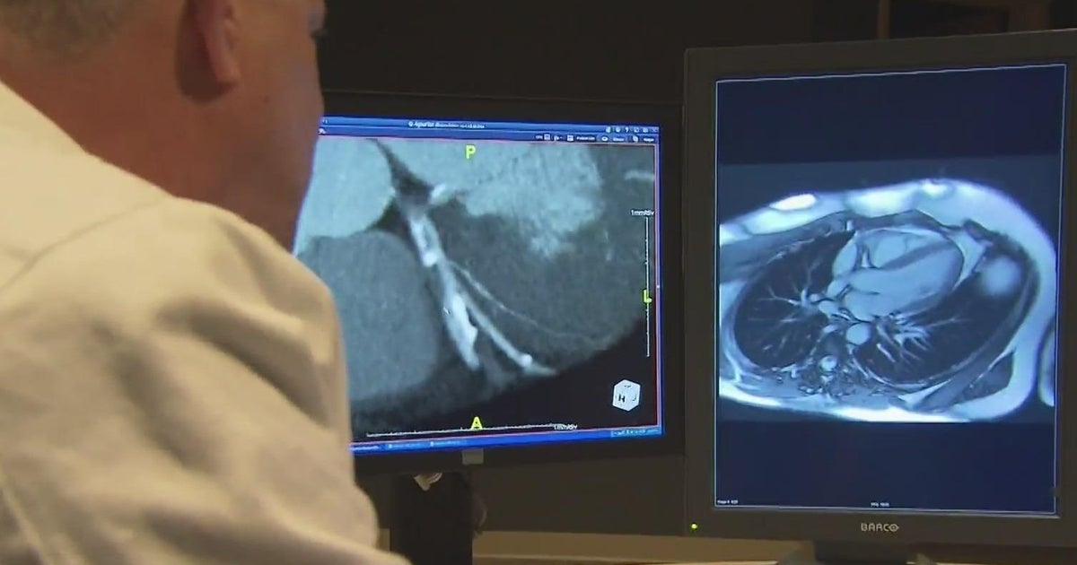 Elite athletes with genetic heart disease may continue competing - CBS ...