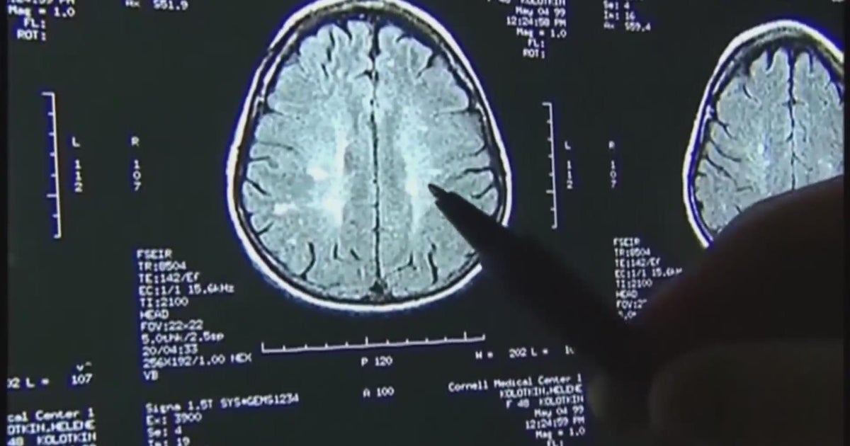 New blood test evaluates concussions, brain injuries - CBS Texas