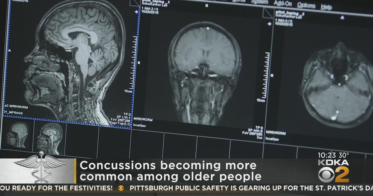 Concussions on the rise among older Americans - CBS Pittsburgh