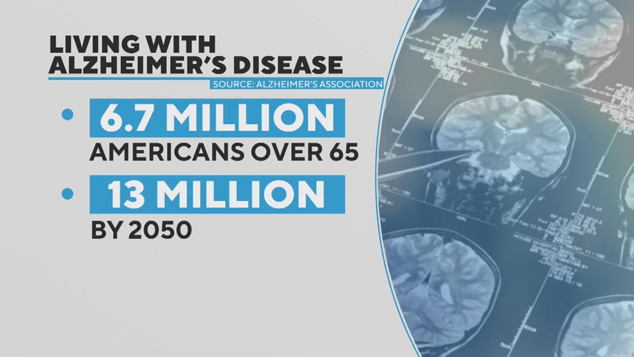 Alzheimer's disease numbers increasing as baby boomers age: study - CBS ...
