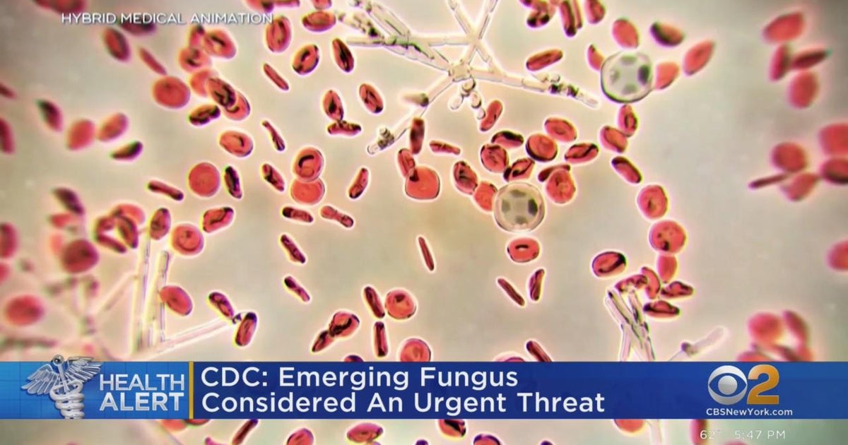 CDC warns of "alarming" rise of potentially deadly fungal threat in ...
