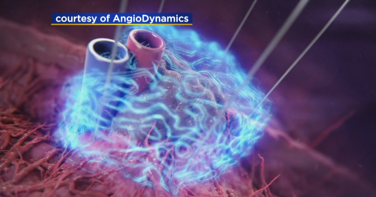 Less invasive treatment for prostate cancer being tested in Philly ...