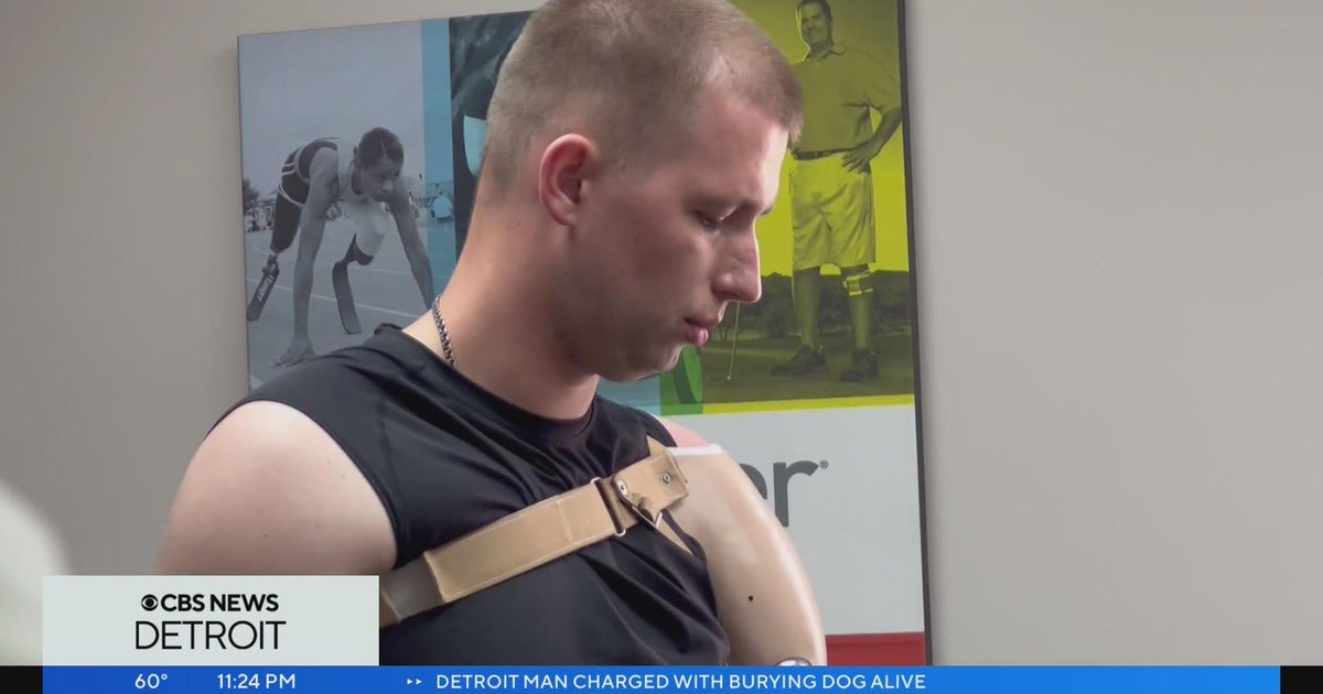 Ukraine soldier who lost arm on battlefield receives prosthetic arm in ...