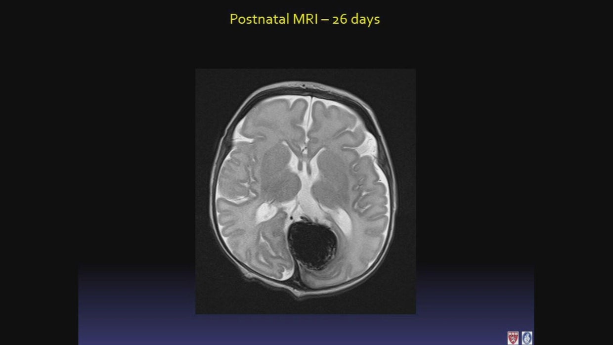 Boston doctors perform groundbreaking brain surgery on baby still in ...