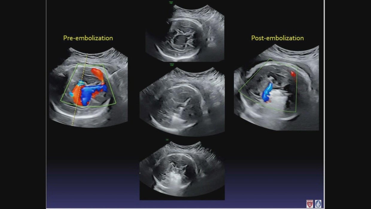 Boston doctors perform groundbreaking brain surgery on baby still in ...