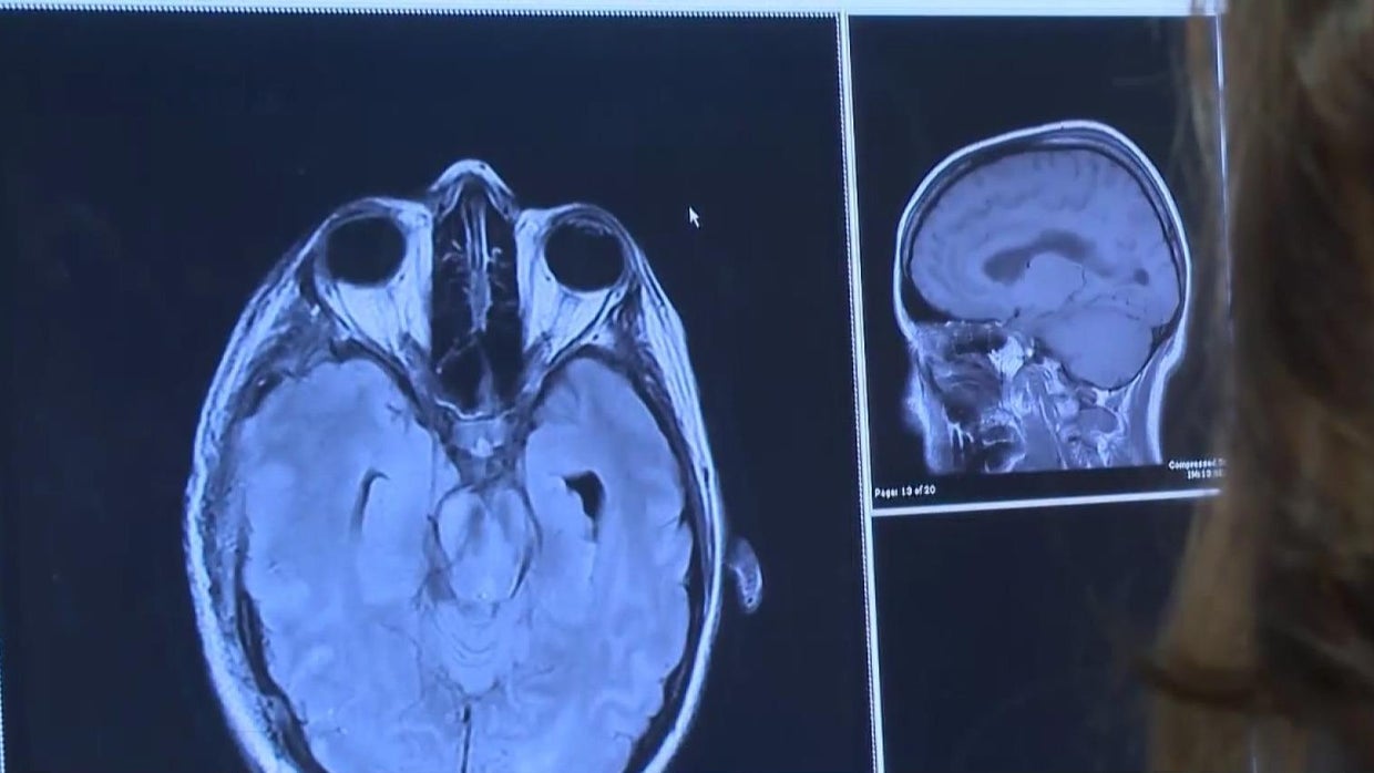 Brain changes after the end of a relationship - CBS Sacramento