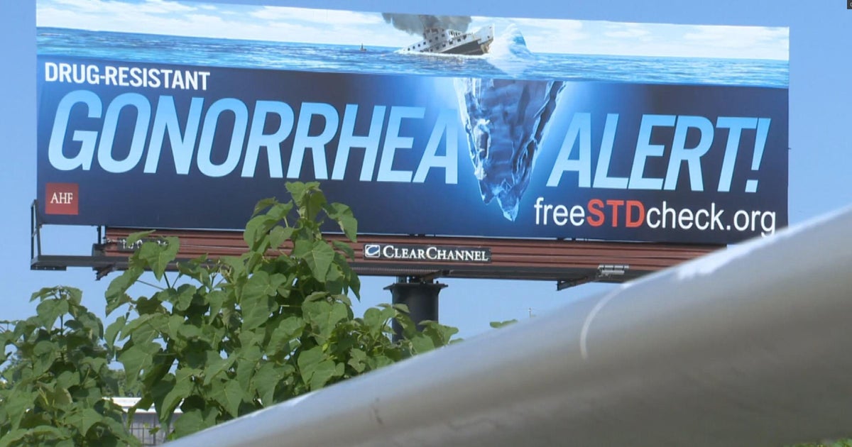 Remington gonorrhea billboard sparks local curiosity - CBS Baltimore