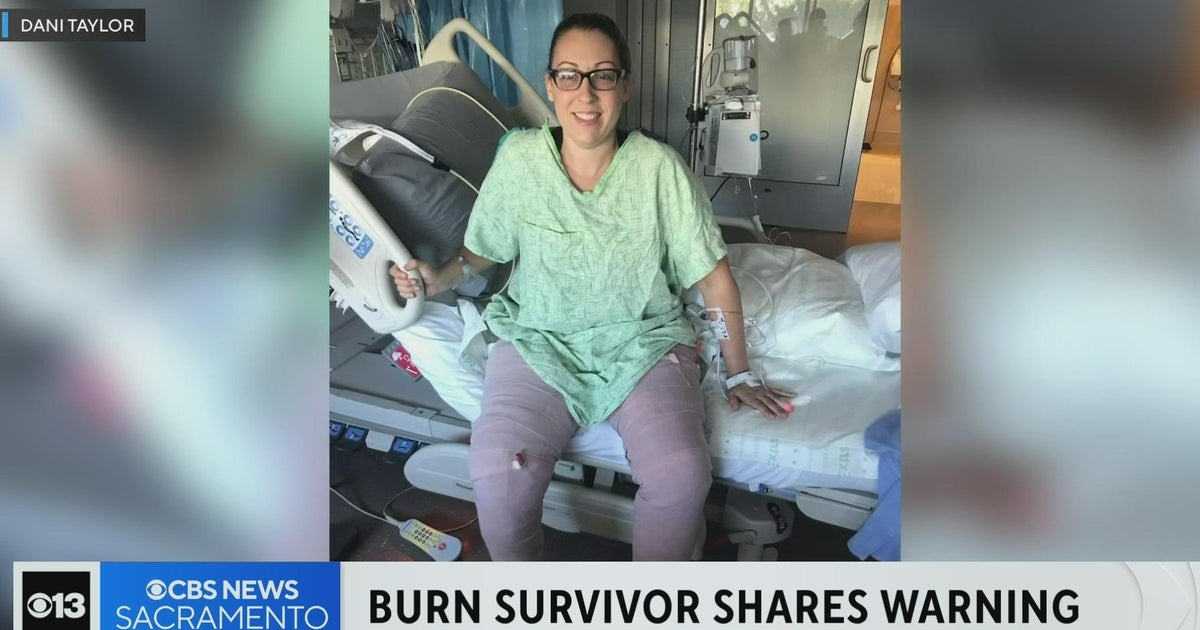 Burn victim shares story and warning after falling into campfire - CBS ...