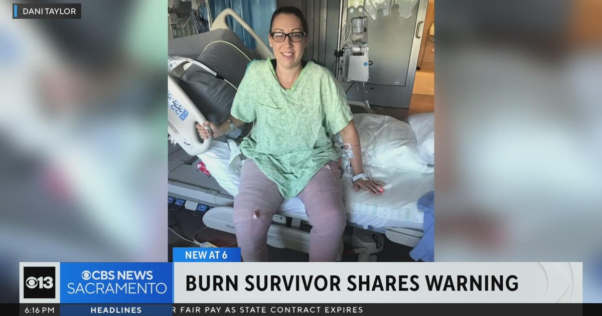 NorCal burn survivor shares warning after falling into campfire - CBS ...