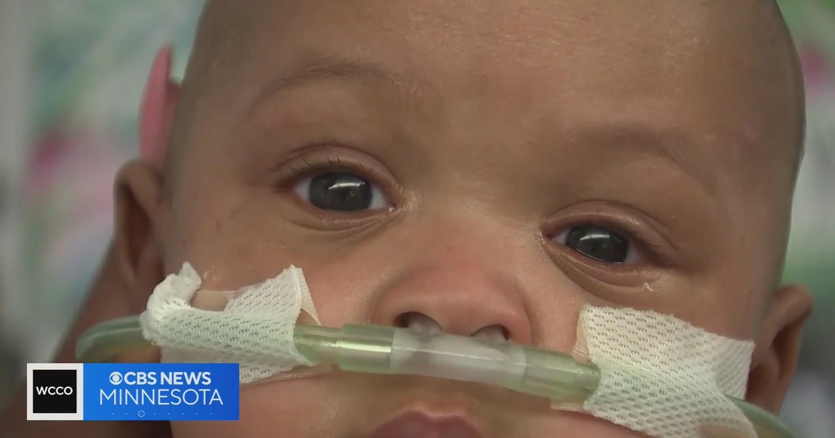 Pennsylvania baby receives smallest pacemaker in the world - CBS Minnesota