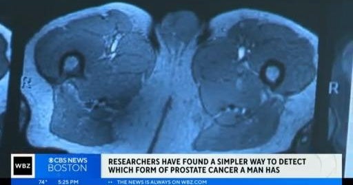New research could help determine treatment plan for prostate cancer ...