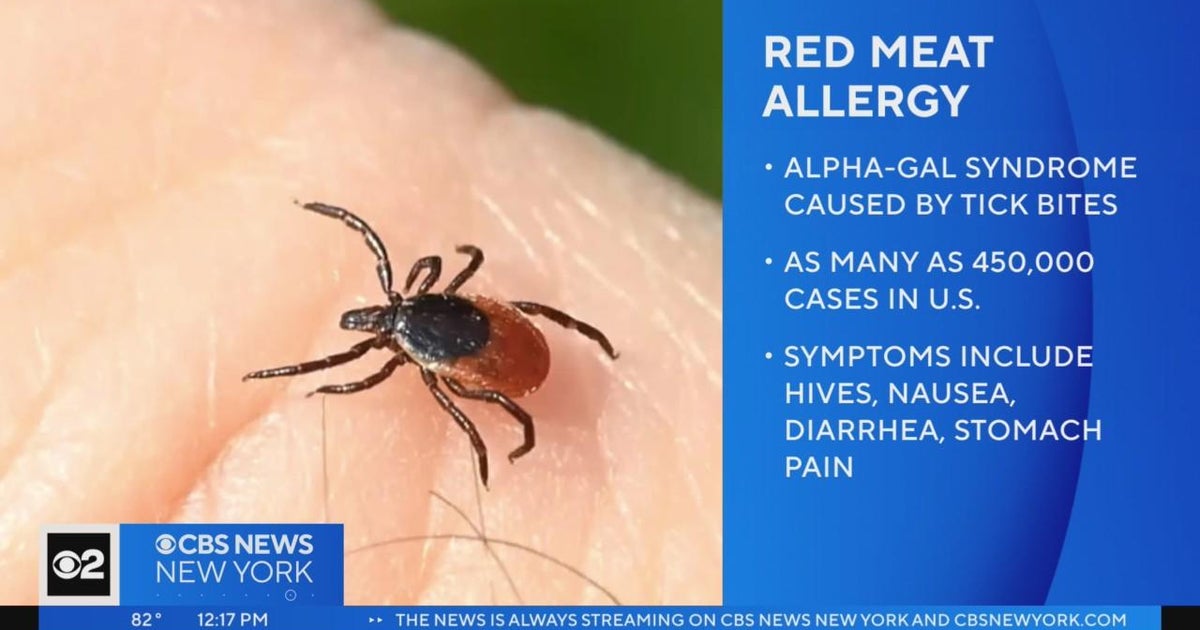 Ticks causing more red meat allergies, CDC says - CBS New York Ticks causing more red meat allergies, CDC says - CBS New York