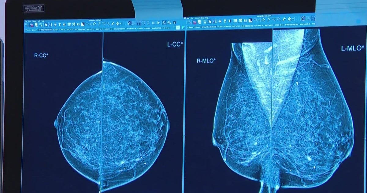 Breast cancer rates are on the rise among younger women - CBS Chicago