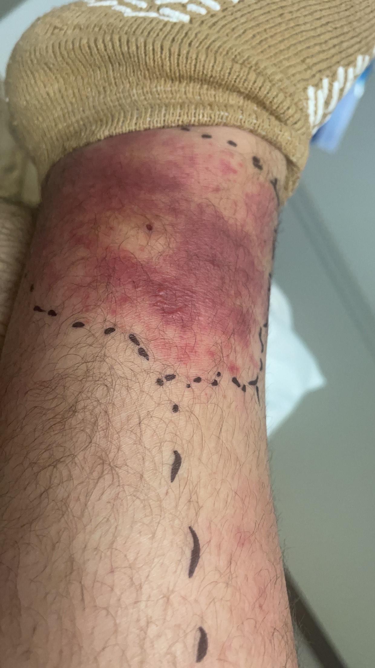 Brown recluse spider bite: What to know after Atlanta man almost lost ...