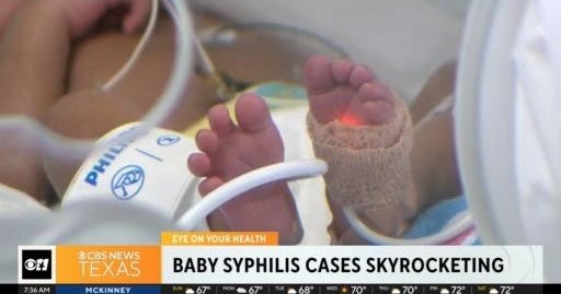 Baby syphilis cases skyrocketing in U.S. - CBS Texas