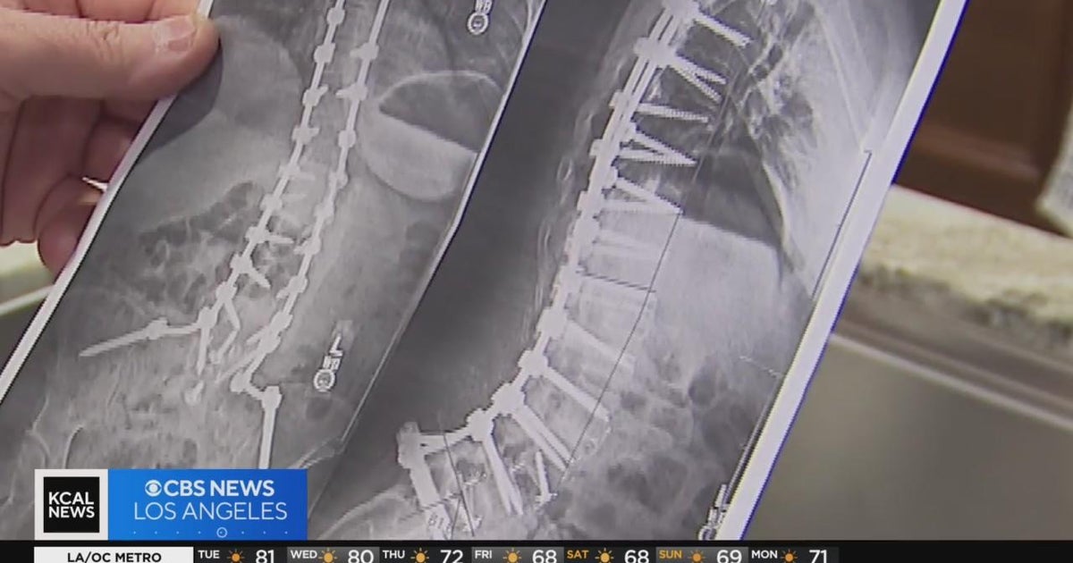 Family of Anaheim teacher sounds alarm on bone material used in ...