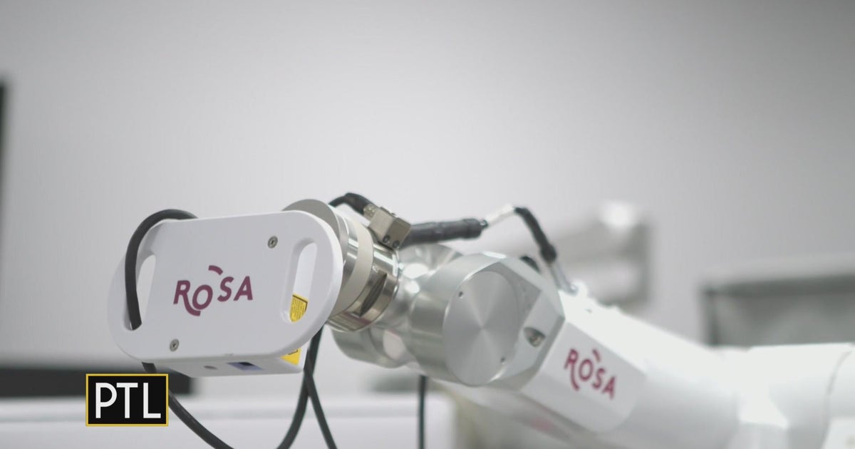 Eye On Health: ROSA robot helping patients with epilepsy - CBS Pittsburgh