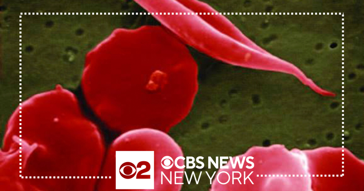 FDA approves gene therapy sickle cell treatment - CBS New York