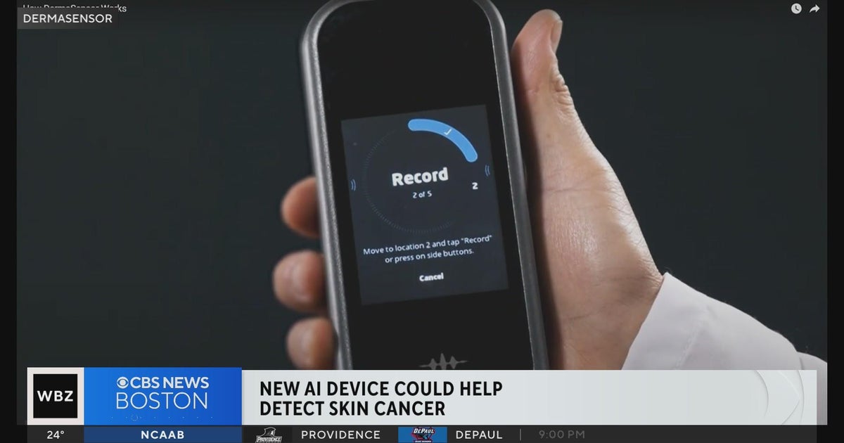 New AI-powered device could help detect skin cancer - CBS Boston