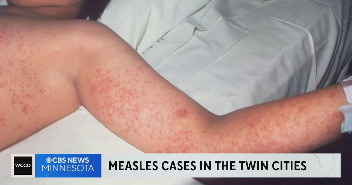 MDH reports 2 new cases of measles in Twin Cities area - CBS Minnesota