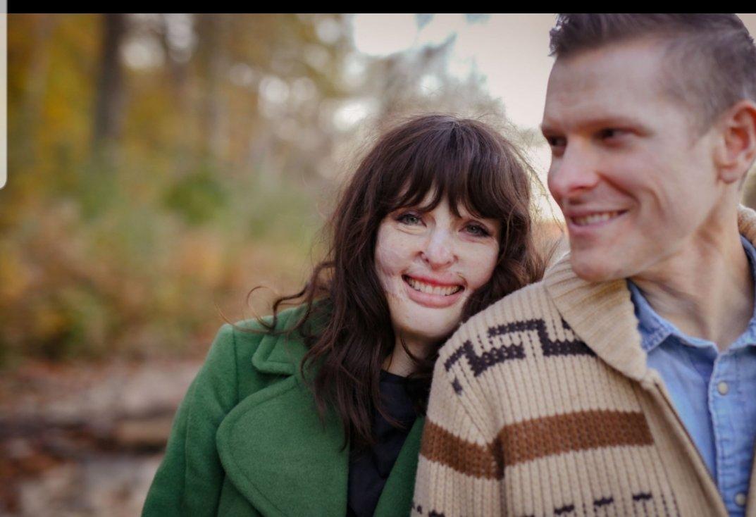 A couple survived a plane crash with burns that would change their ...