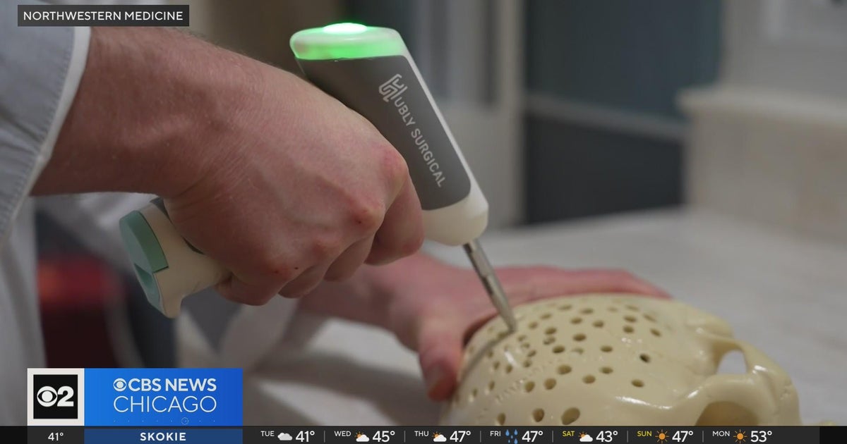 Northwestern student develops battery-powered brain drill - CBS Chicago