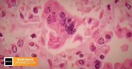 What parents need to know about measles - CBS Minnesota