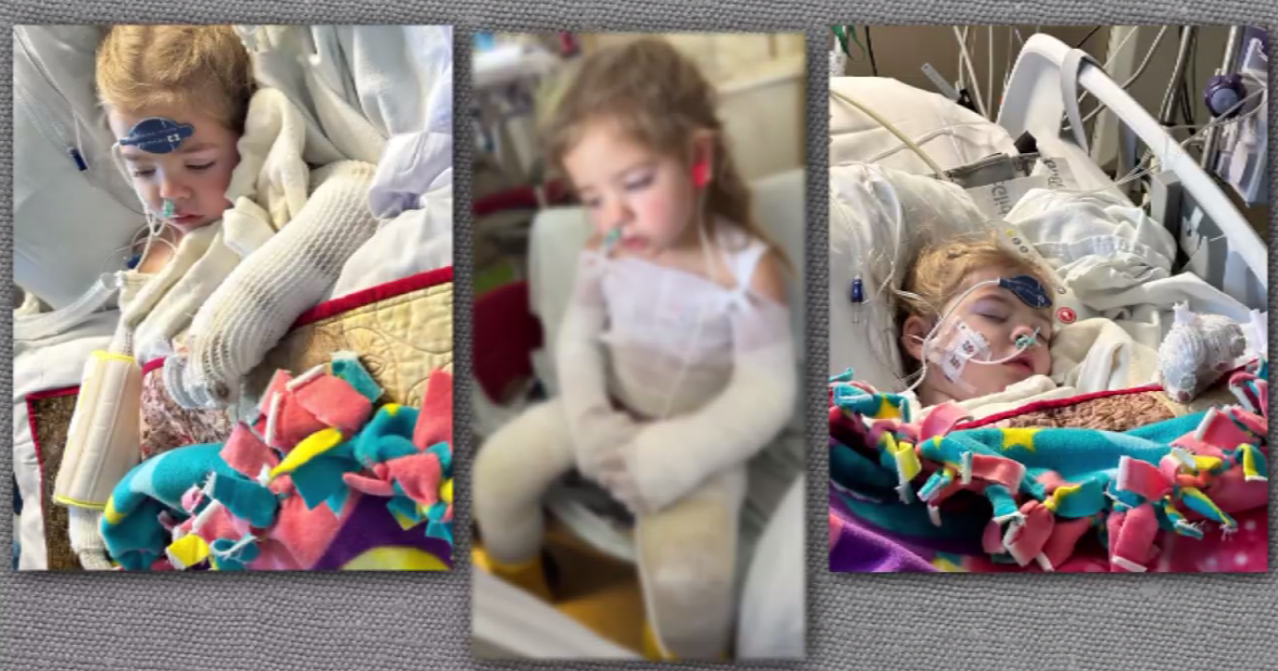 Loyola Chicago burn center doctors help kids heal physically - CBS Chicago