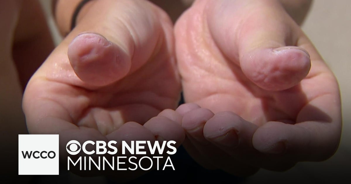Why does skin prune while in water? - CBS Minnesota