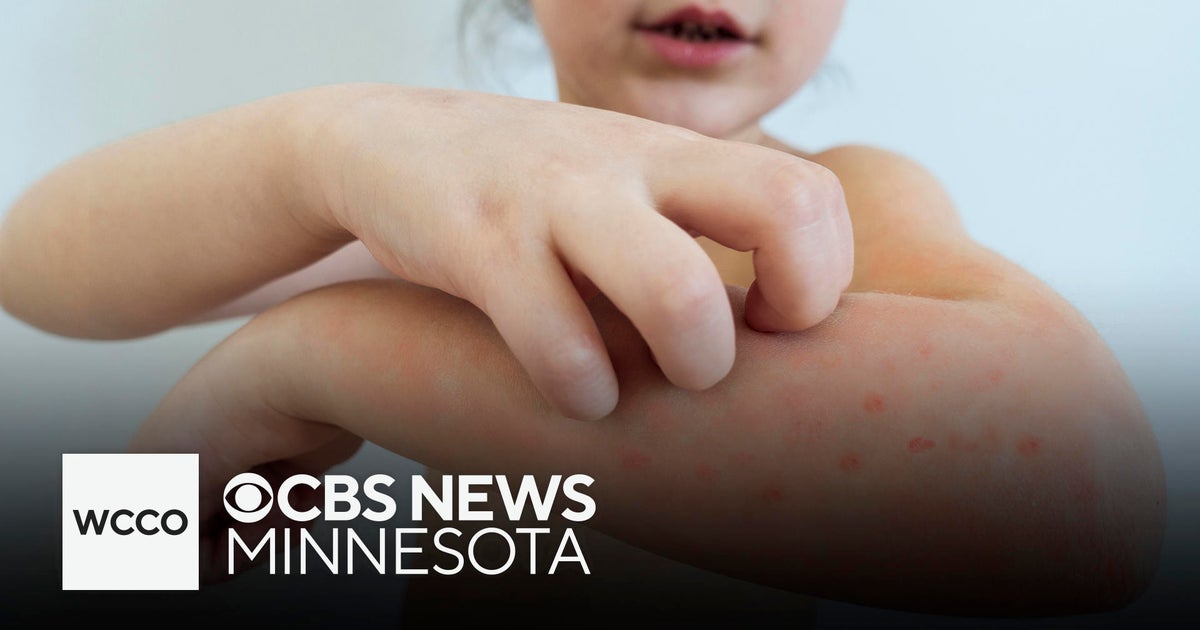 Does your kid have a summer rash? Here's what you need to do. - CBS ...