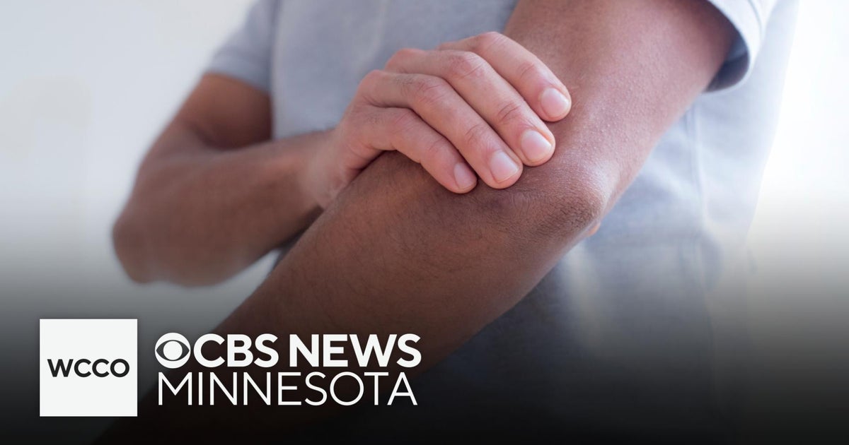 Why does hitting your funny bone hurt? - CBS Minnesota
