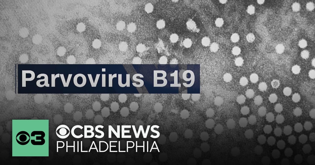 CDC issues new warning about increasing cases of Parvovirus B19 - CBS ...
