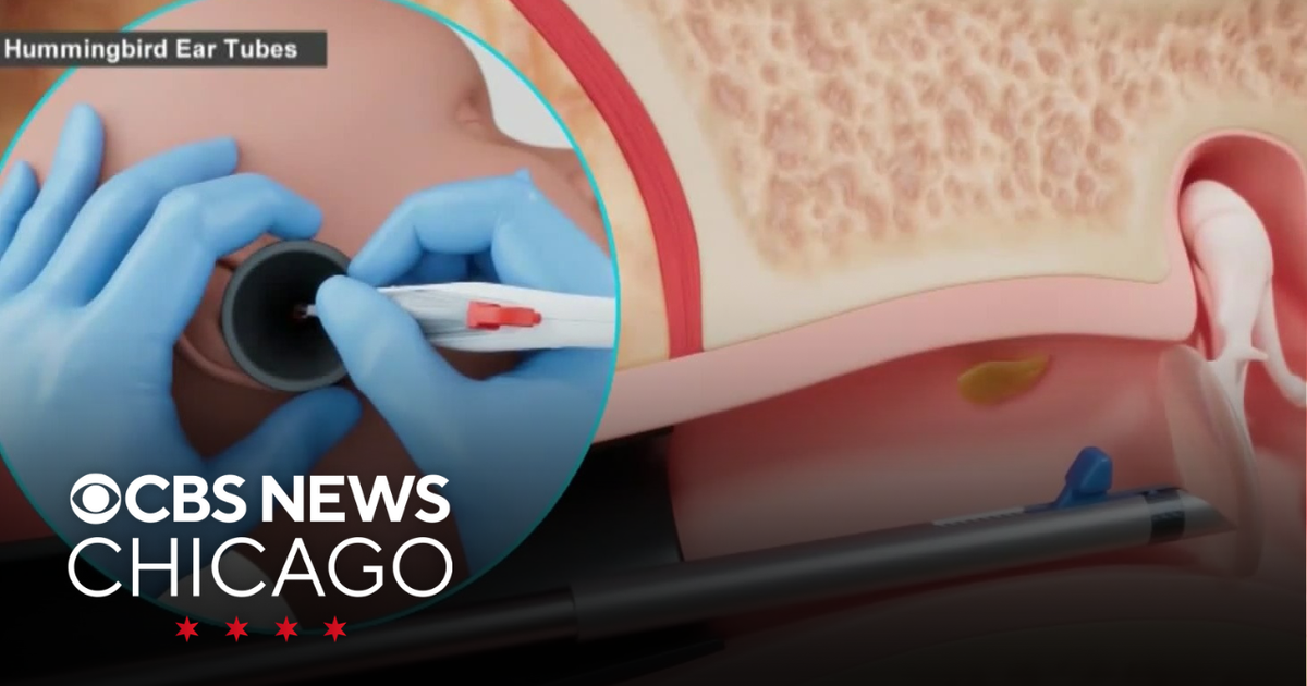 FDA clears new device for ear tube surgeries - CBS Chicago