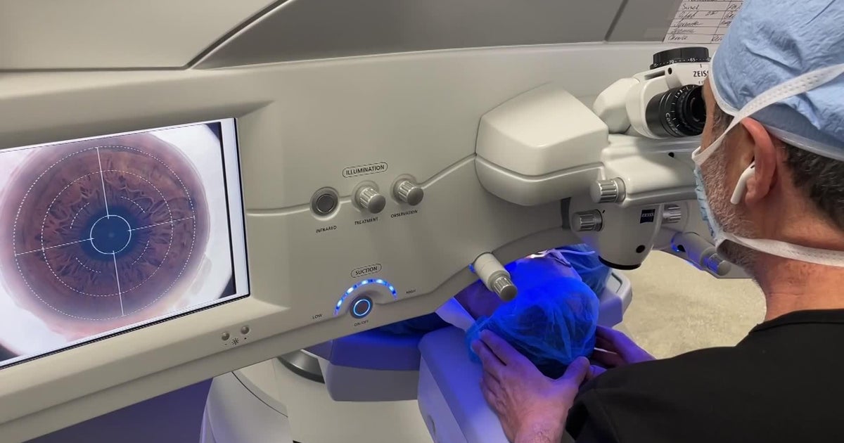 Color your eyes? It's the new trend in cosmetic procedures - CBS Miami