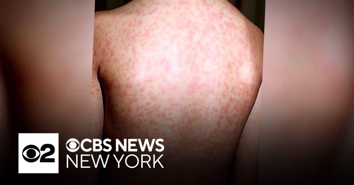 Measles cases in New Jersey spark health warning - CBS New York