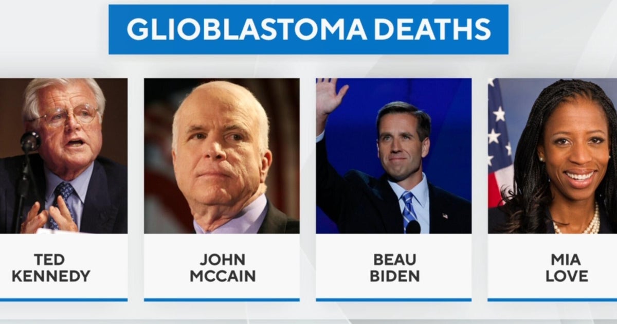 What is the aggressive brain cancer glioblastoma? - CBS News