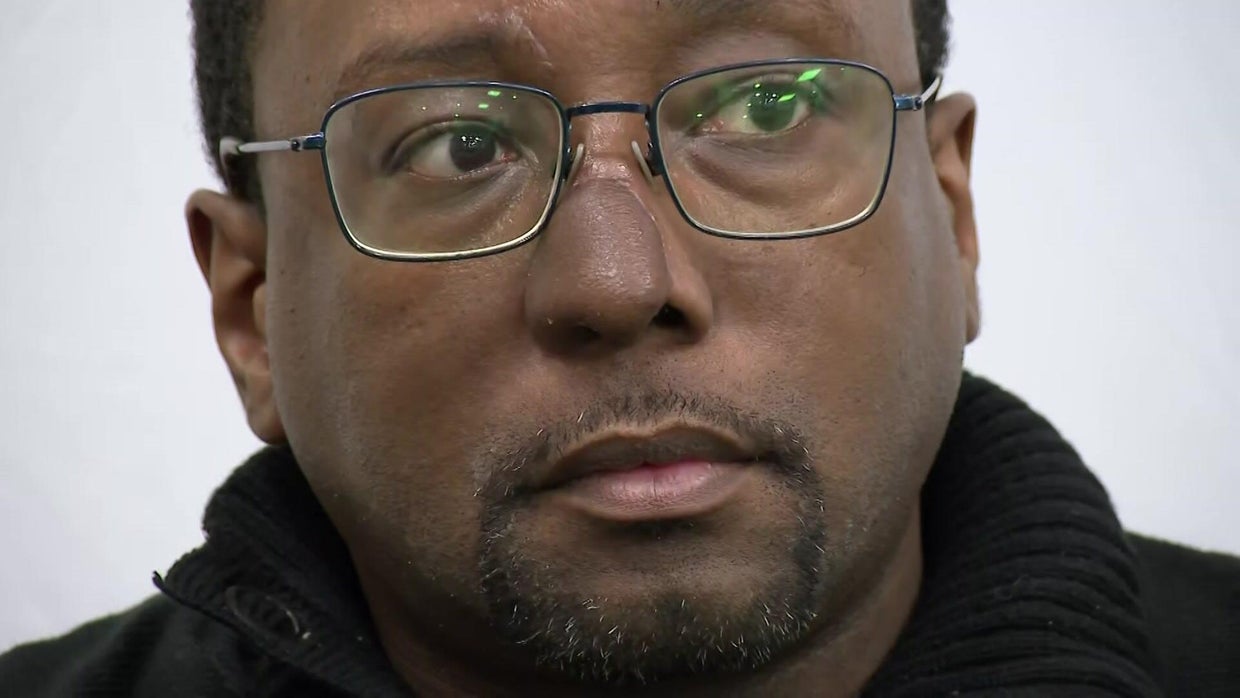 Long Island man whose nose was bitten off sees incredible ...
