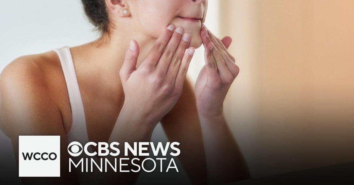 Why this popular TikTok trend is concerning doctors - CBS Minnesota
