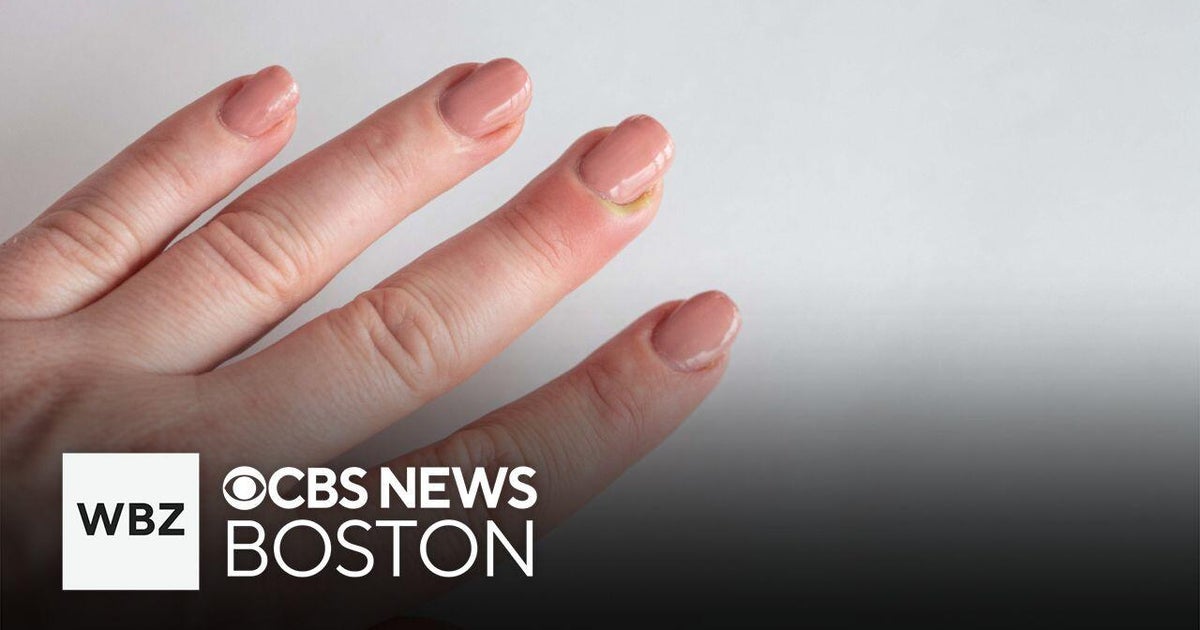What is a paronychia and how can it be treated? - CBS Boston