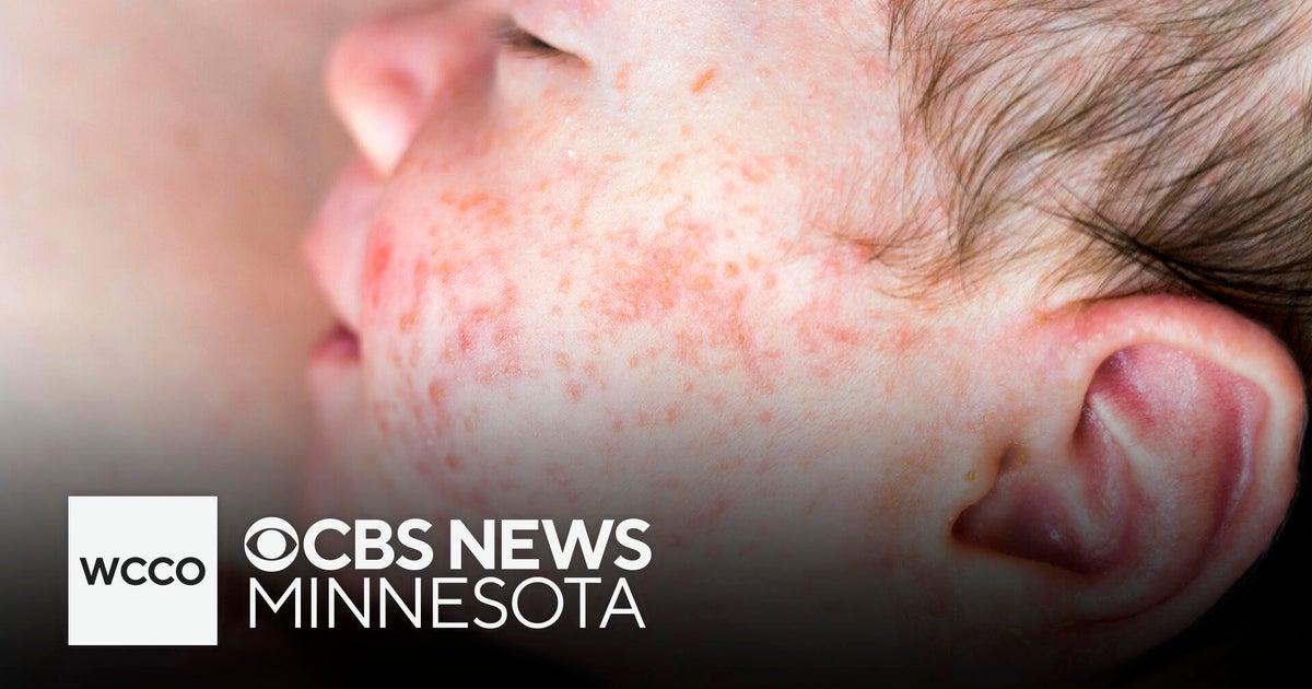 What to know about newborn skin conditions that may crop up after ...