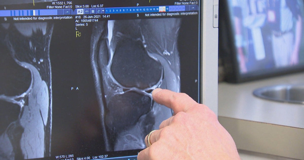 Less invasive knee procedure uses patient's own cells to repair ...