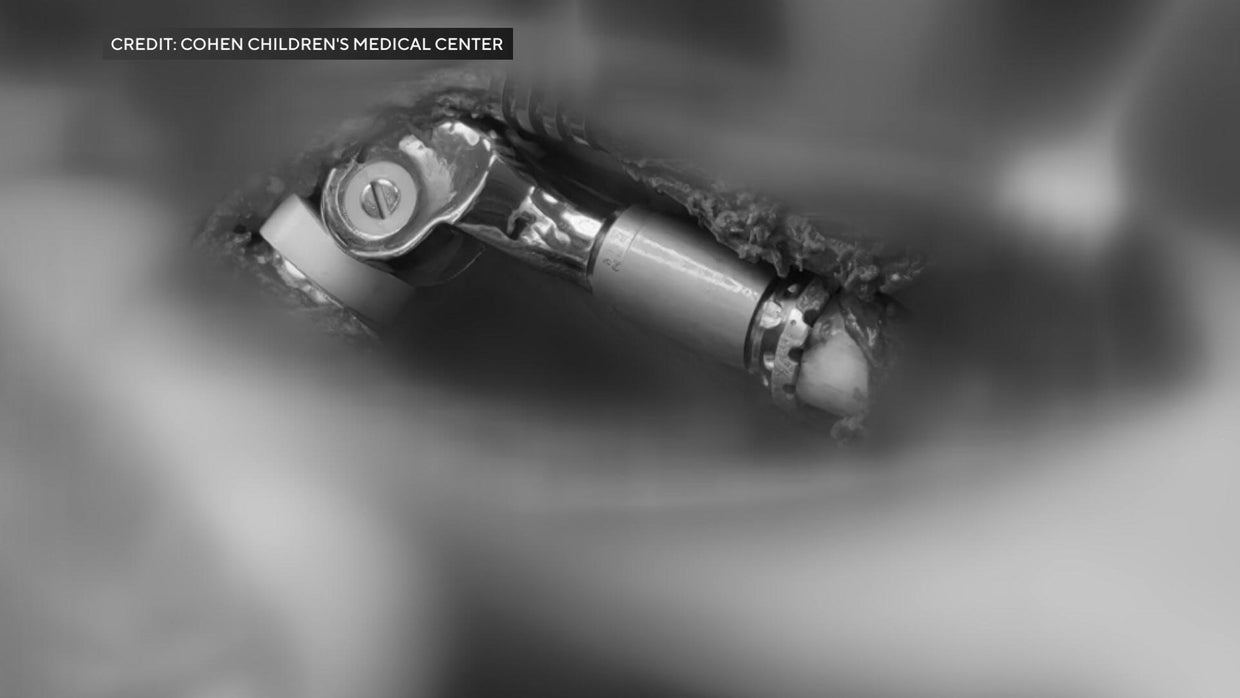 Breakthroughs in cancer treatment spare Long Island teen from leg ...