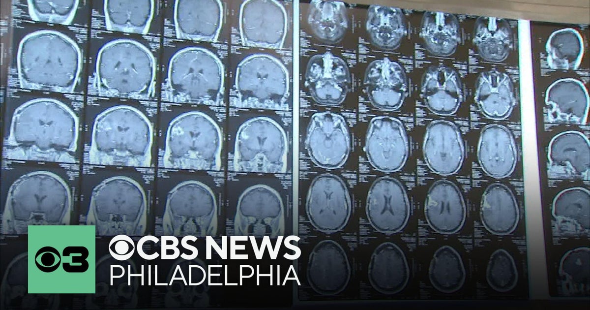 What is CTE? A Philadelphia doctor explains the brain condition ...
