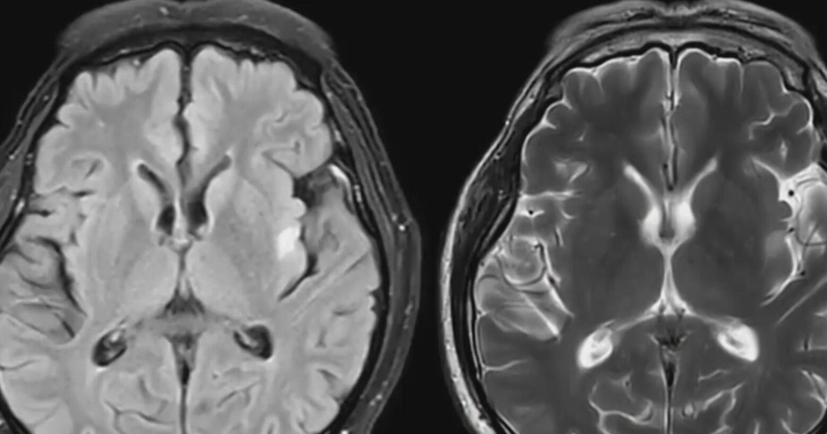 UCSF study on CTE seeks living athletes' data to help diagnose the ...