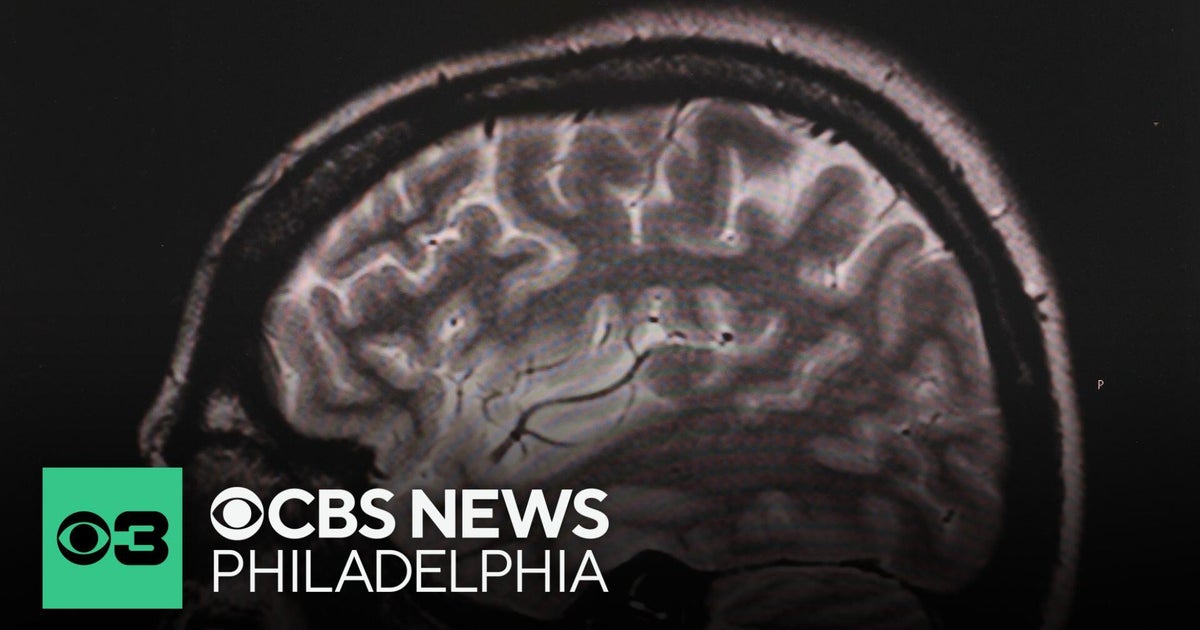 Doctors believe new medicines can slow progression of Alzheimer's ...