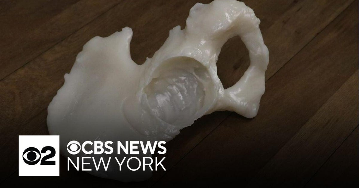 Doctors use 3D printing to replace woman's shattered pelvis - CBS New York